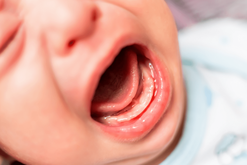 Tongue And Lip Ties 101 Navigating Parenthood